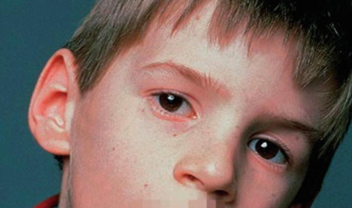 Hirnnervenparesen | SpringerLink