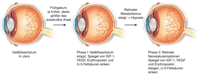 Frühgeborenenretinopathie | Springer Nature Link