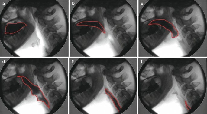 Dysphagie in der neurologischen Rehabilitation | SpringerLink