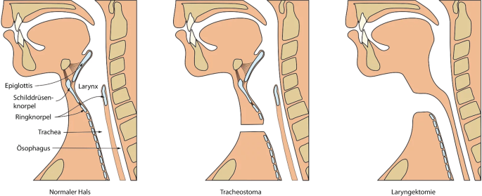 Pflege von Patientinnen und Patienten mit Tracheostoma | SpringerLink