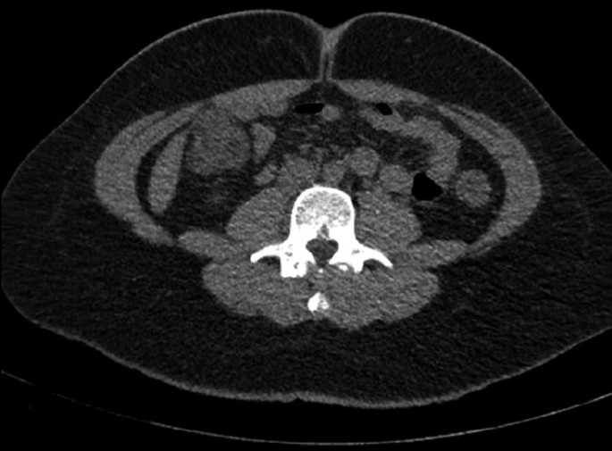 Der Patient mit Hernie und morbider Adipositas: Wann und was zuerst ...