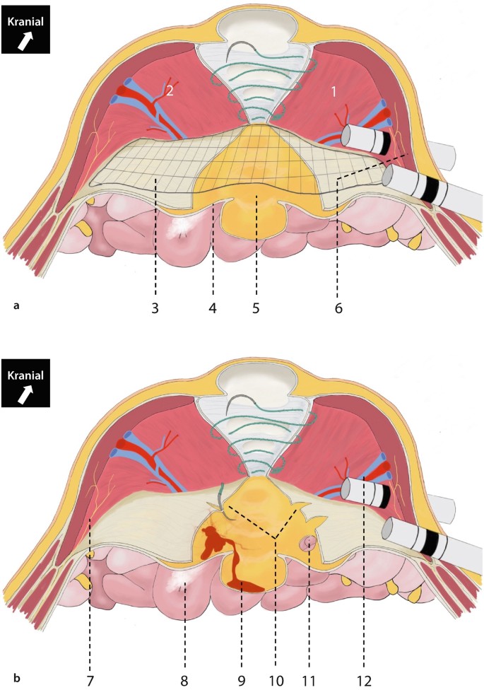 Robotische eTEP für umbilikale und epigastrsche Hernien | Springer ...