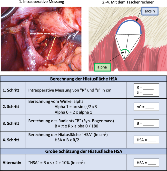 Leitlinien und Klassifikation: Hiatushernien | SpringerLink