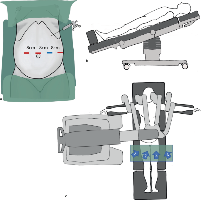 Robotische Hiatushernienversorgung | SpringerLink