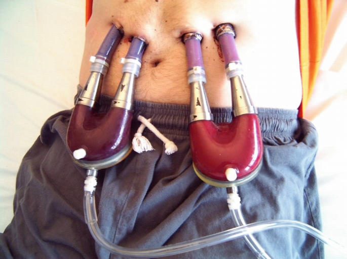 Mechanische Kreislaufunterstützung | SpringerLink