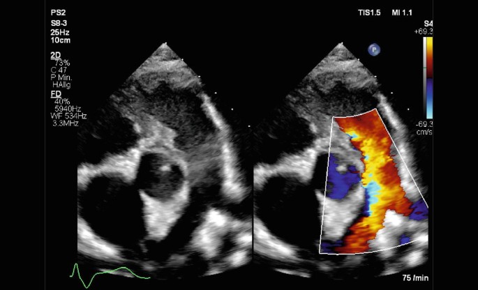 Acquired Diseases of the Pulmonary Valve | Springer Nature Link