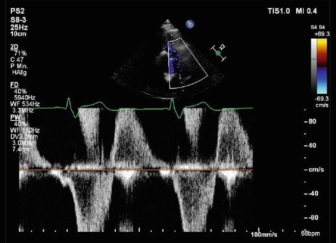Acquired Diseases of the Pulmonary Valve | Springer Nature Link