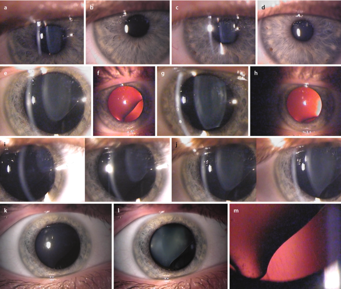 Lens | SpringerLink