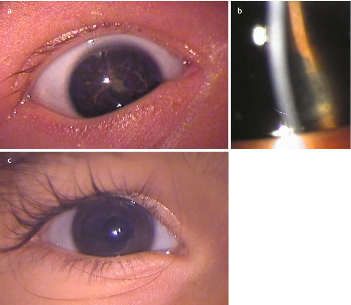 Lens | SpringerLink