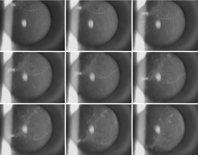 Vitreous | Springer Nature Link