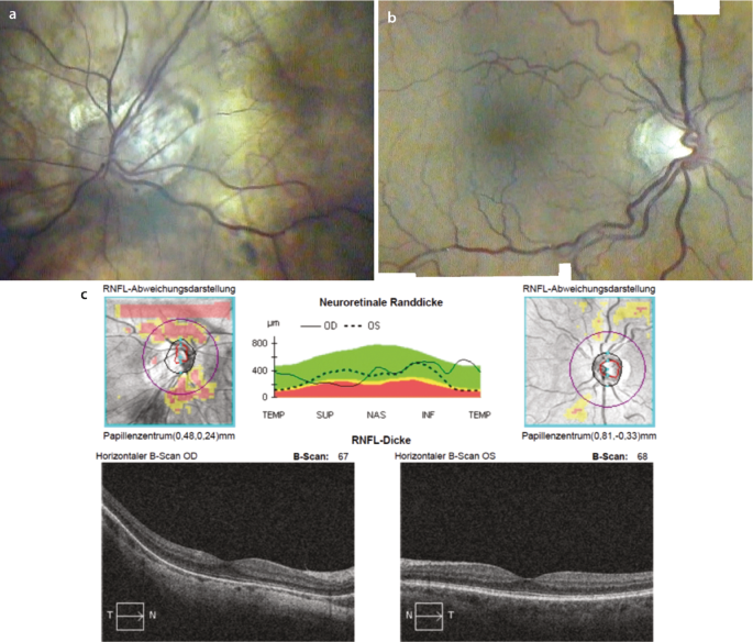 Optic Nerve | SpringerLink