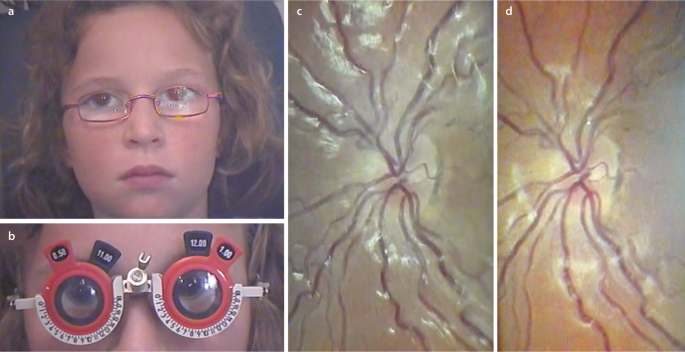 Optic Nerve | SpringerLink