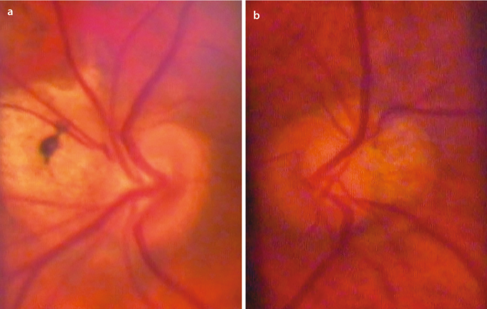 Optic Nerve | SpringerLink