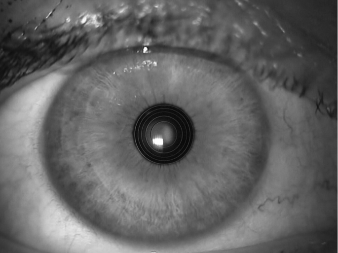 Anterior Segment | SpringerLink