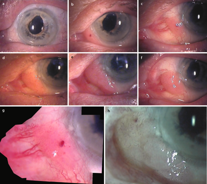 Conjunctiva and Sclera | Springer Nature Link