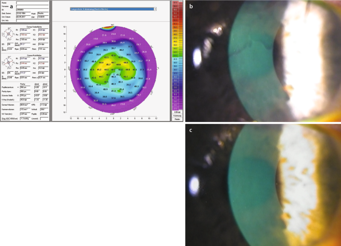 Cornea | SpringerLink