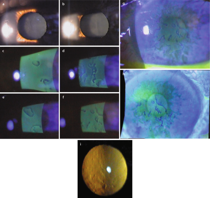 Cornea | SpringerLink