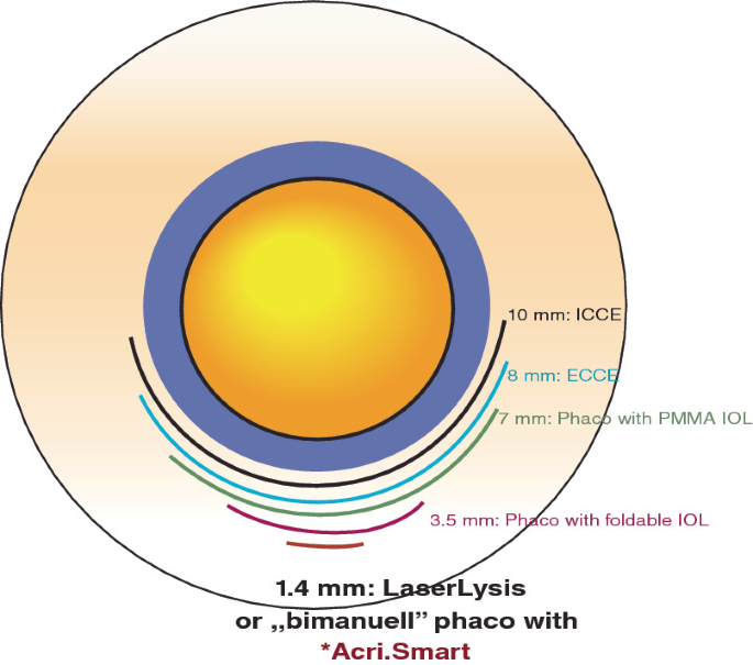Intraocular Lenses—An Overview | SpringerLink