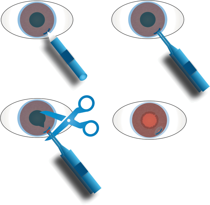 Iridectomy | SpringerLink