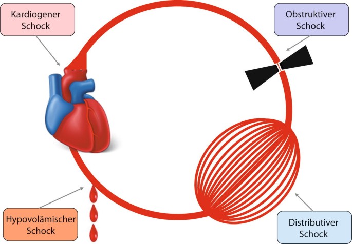 Schock und Schockformen | SpringerLink
