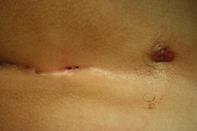 Sinus pilonidalis | SpringerLink