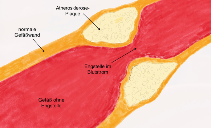 Arteriosklerose | Springer Nature Link