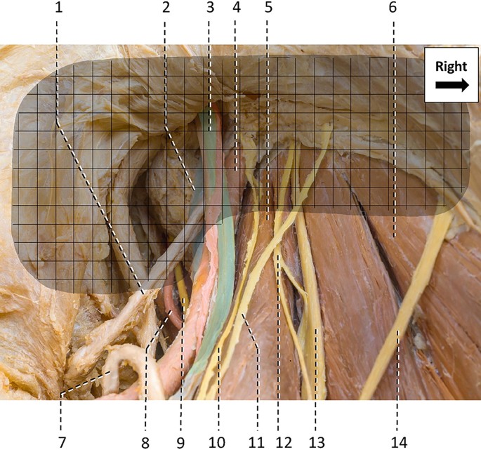 Robotic-Assisted Mesh Explantation from the Groin | Springer Nature Link