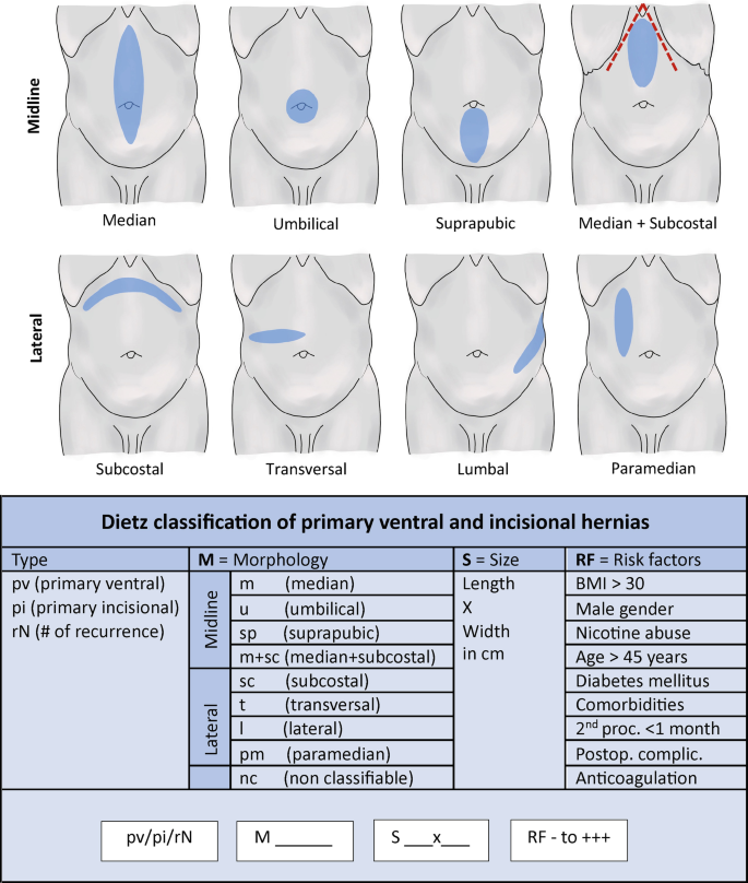 Guidelines and Classification: Incisional Hernias | Springer Nature Link