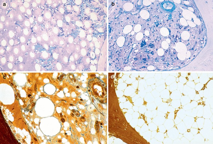 Definitions, Forms, and Pathogenesis of BME | Springer Nature Link