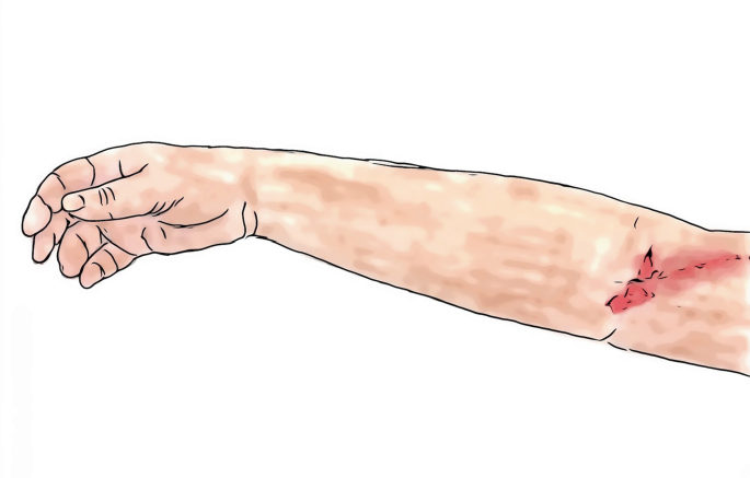 Thrombophlebitis of the Arm Veins | Springer Nature Link