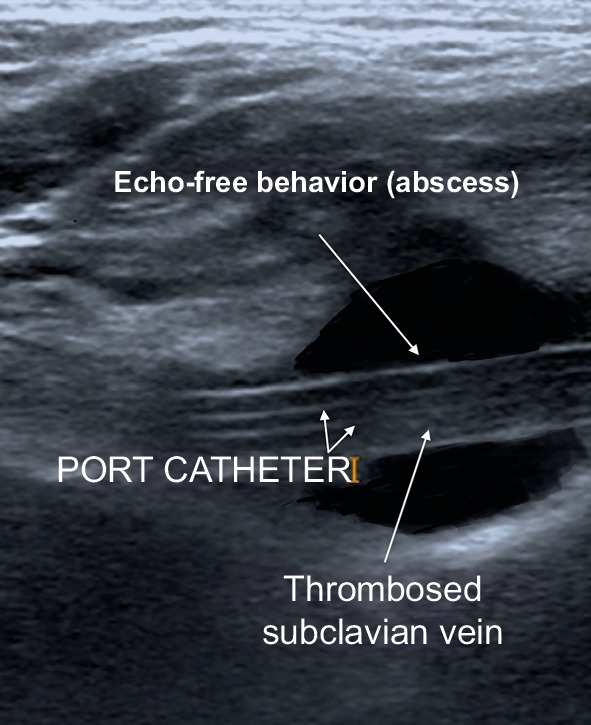 Infection of a Port Catheter | Springer Nature Link
