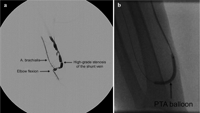 Shunt Occlusion | Springer Nature Link
