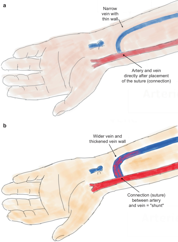 Kidney Failure and Dialysis | Springer Nature Link