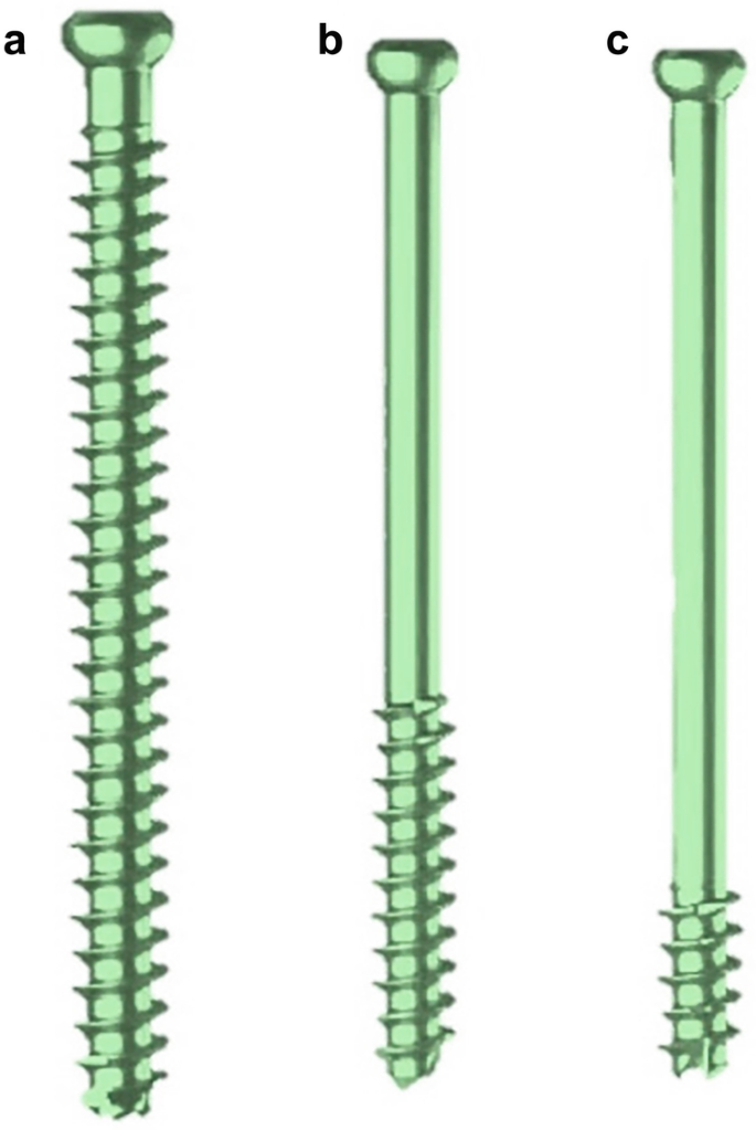 Importance of Orthopaedic Screws | SpringerLink