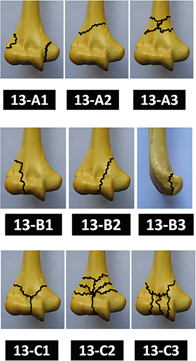 Implantology of Fractures of the Distal Humerus | SpringerLink