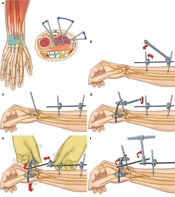 Fracture of the Distal Radius | SpringerLink
