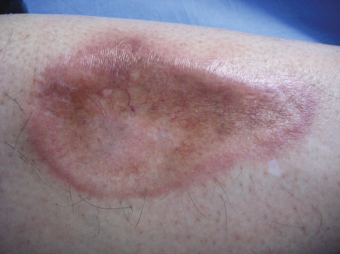 Other Nonmelanic Pigmentary Disorders | SpringerLink