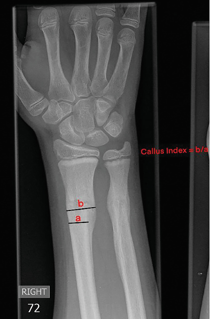 Defining the Clinical and Radiological Endpoint of a Successfully Fixed ...