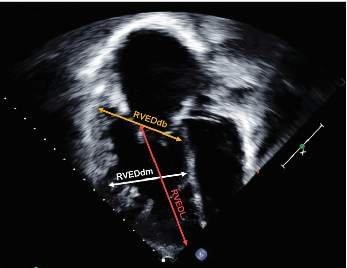The Echocardiographic Assessment of Right Ventricular Function and ...