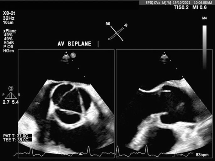 Three-Dimensional Echocardiography Imaging | SpringerLink