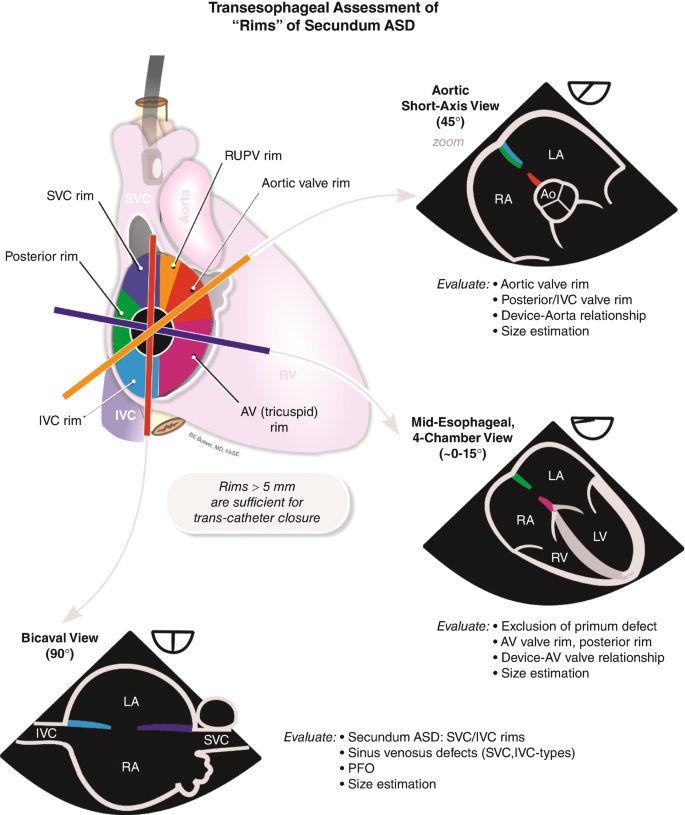 Transesophageal Echocardiography (TEE) | SpringerLink