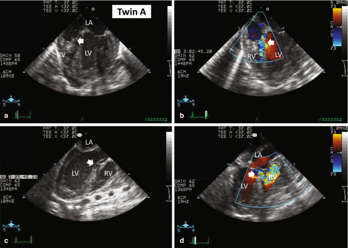 Echocardiographic Evaluation of Cardiovascular Anomalies in Conjoined ...