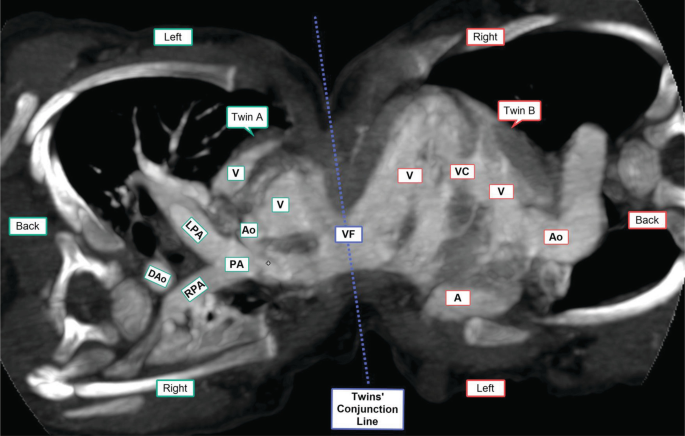Echocardiographic Evaluation of Cardiovascular Anomalies in Conjoined ...