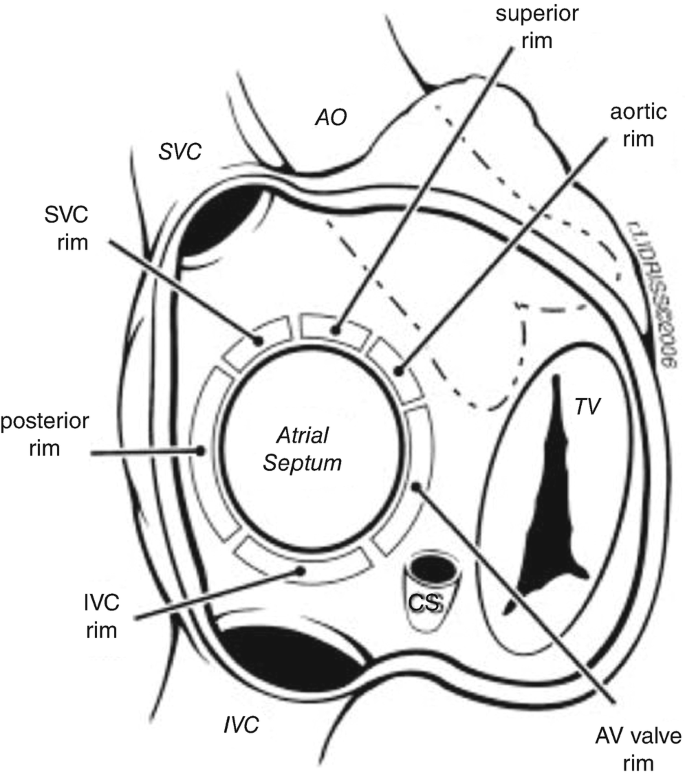 Catheter-Based Closure of Shunt Lesions | SpringerLink