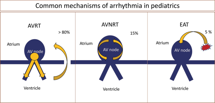 Acute Arrhythmia Management Protocol | SpringerLink