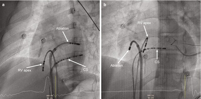 Pediatric Cardiac Electrophysiology Study (EPS) and Catheter Ablation ...