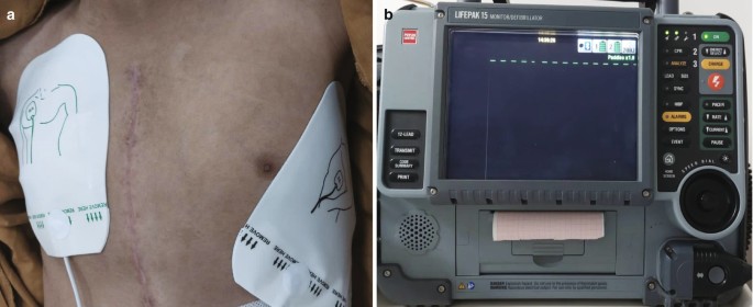 A Brief Manual of Defibrillation and Cardioversion | SpringerLink