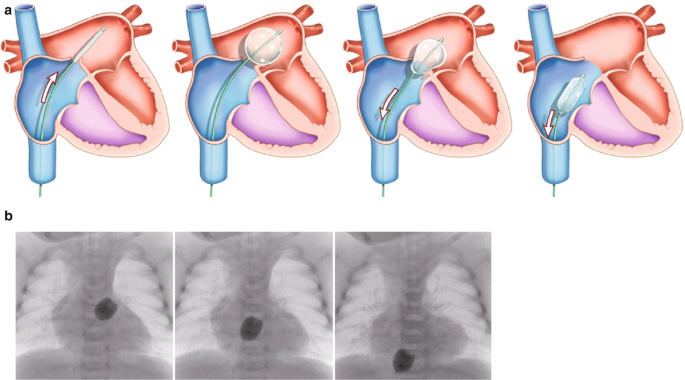 Balloon Atrial Septostomy | SpringerLink