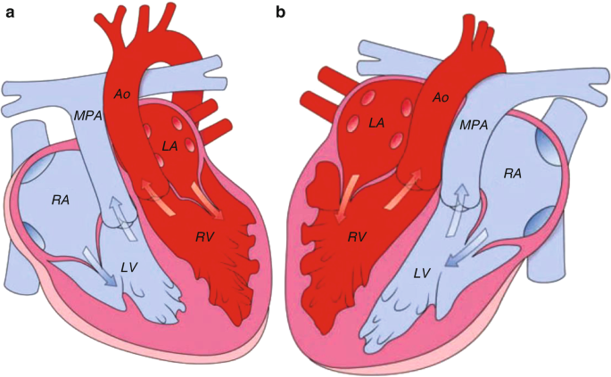 Congenitally Corrected Transposition of the Great Arteries (ccTGA ...