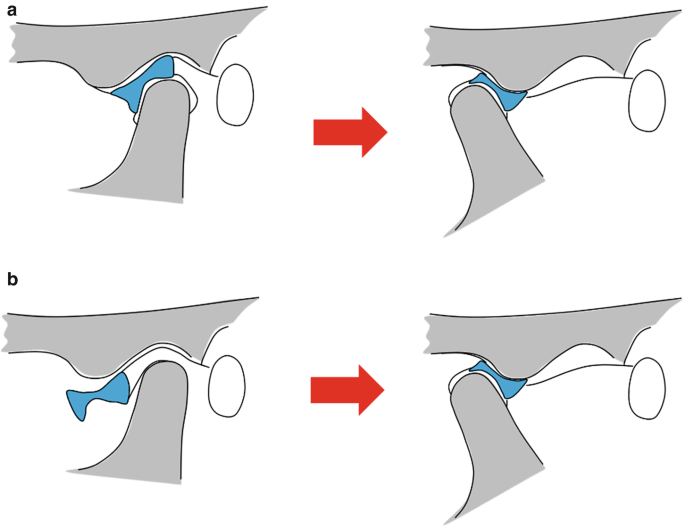 Treatment for Condylar Dislocation | Springer Nature Link